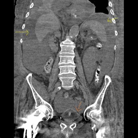 Catheter Noted In A Decompressed Bladder Red Arrow Download