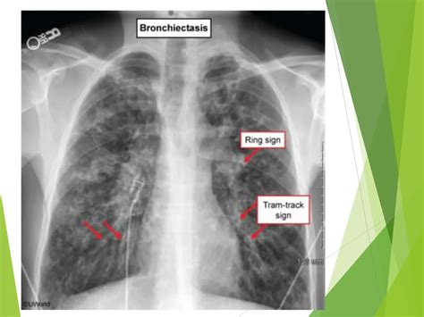 Diagnosis And Imaging Of Bronchiectasisppt Lung And Respiratory