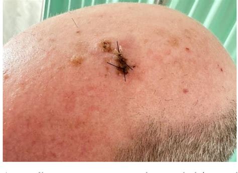 Figure 2 From Adenosquamous Carcinoma Of The Skin A Case Report