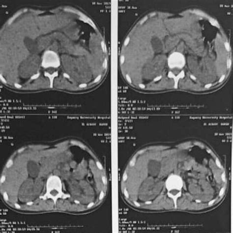 Abdominal Ct Scan Of 50 Year Old Patient Showing Resolution Of The