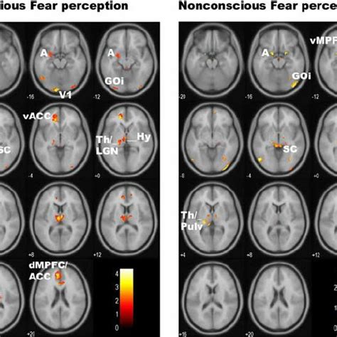 Statistical Parameter Maps For The Regions Of Interest Activated In Download Scientific Diagram