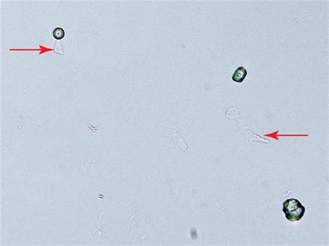Starch In Urine