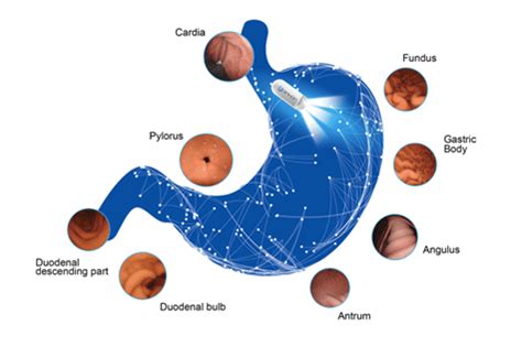 NaviCam™ Stomach Capsule System - A SAGES Technology and Value Assessment