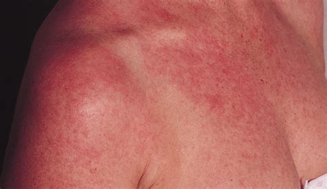 The Diagnosis Of Photosensitivity Dermatology Jama Dermatology Jama Network