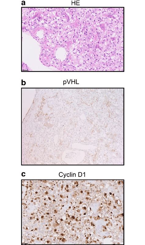 Molecular Analysis Of The Tumor After Surgical Removal Of The Clear