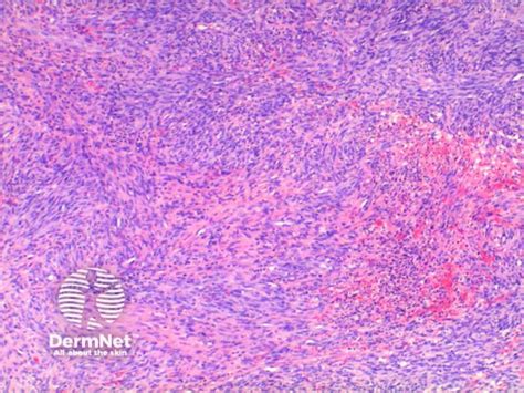 Kaposi Sarcoma Histology Kaposi Sarcoma Small Early Lesions Case