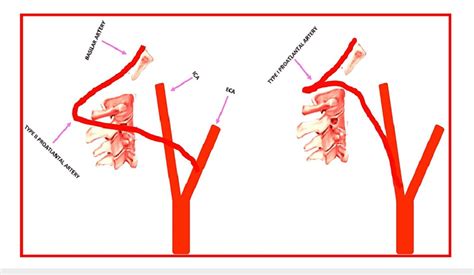 Types Of Proatlantal Intersegmental Artery Type I Which Originates