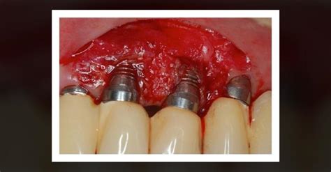 Soft Tissue Management Around Dental Implants Medsynapse