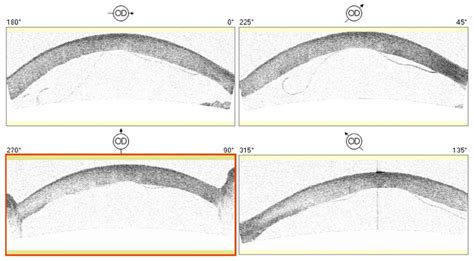 Graft Detachments In Dsaek And Dmek Eyeworld