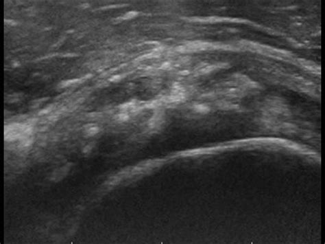 Musculoskeletal Joints And Tendons 61 Shoulder Case 6118 Bursa