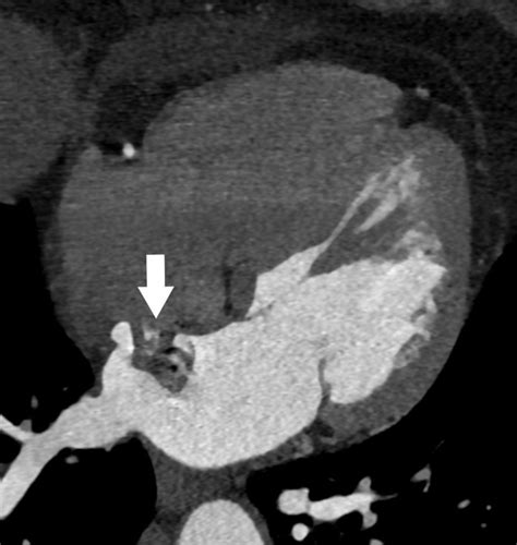 Multimodality Imaging Of Cardiac Myxomas Pmc