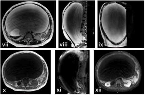 Radiology Community Dielectric Shading Artifacts In High Field