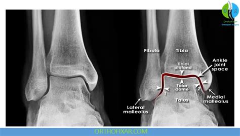 Ankle X Ray Imaging Views Indications And Syndesmosis Criteria