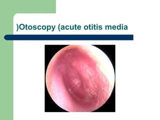 Otitis Media Ppt