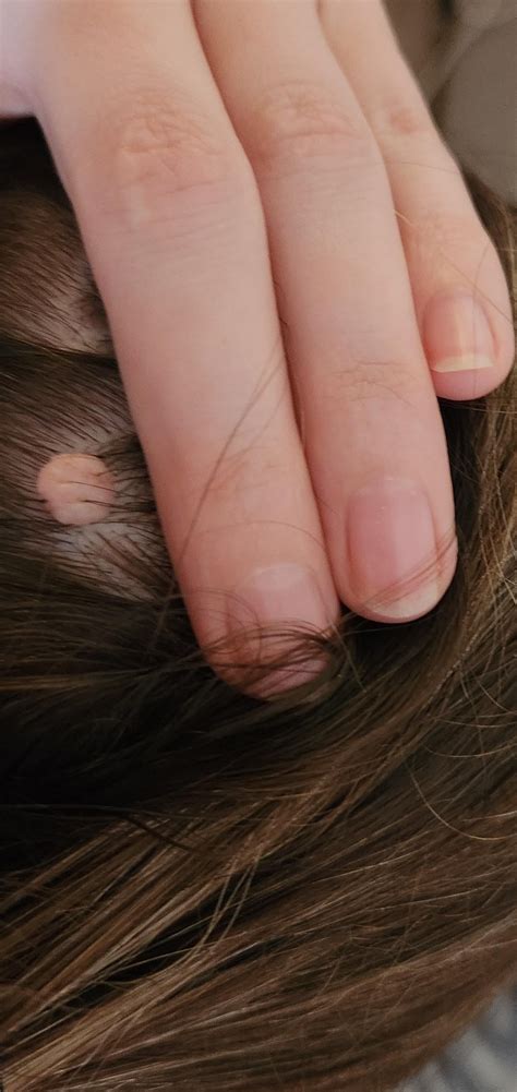 Mole On Scalp Rdermatologyquestions