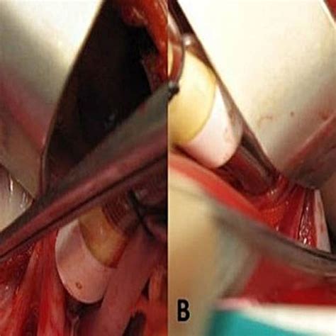 The Operative View Demonstrates The Supra Mitral Ring White Arrows