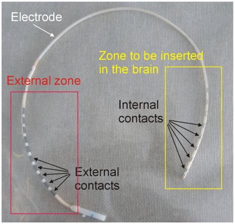 Example Of Seeg Electrode Consisting Of Metal Contacts Joined In Pairs Download Scientific