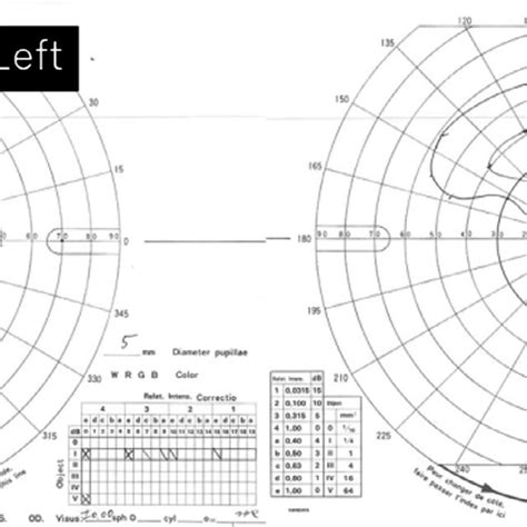 Perimetry Of The Patient Shows Right Sided Inferonasal Quadrantanopia Download Scientific