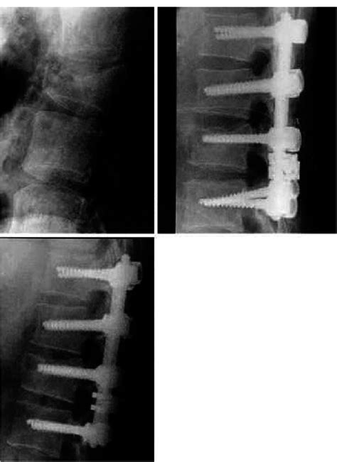Fig B Long Segment Transpedicular Fixation 2 Levels Above 1level Download Scientific Diagram