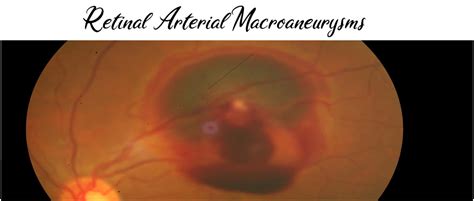 Retinal Arterial Macroaneurysms