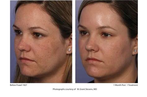 Co2 Laser Before And After Results By Skin Concern 2025