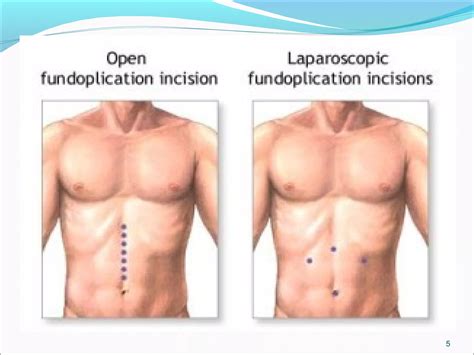 Fundoplication And Hellers Myotomy Ppt