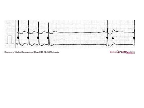 Ecg Lecture Sinus Arrest Sinoatrial Exit Block Av Block And Escape Rhythms Ppt Heart And