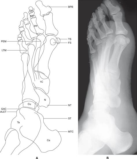 Normal Top Of Foot X Ray