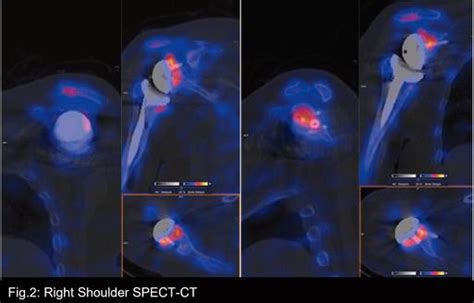 How Spect Ct Helps To Clarify Severe Pain 1 Year After Shoulder