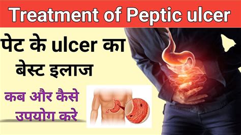 पेट के Ulcer का बेस्ट इलाज L Treatment Of Peptic Ulcer Youtube
