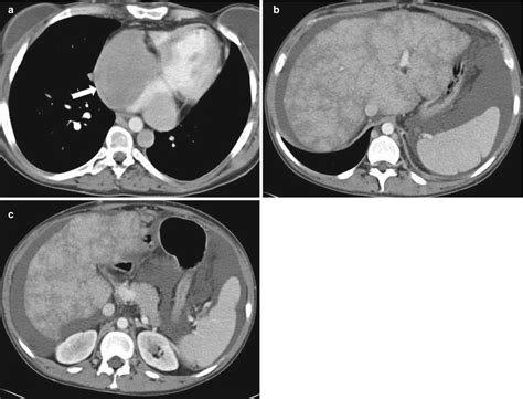 The Biliary Tree Radiology Key