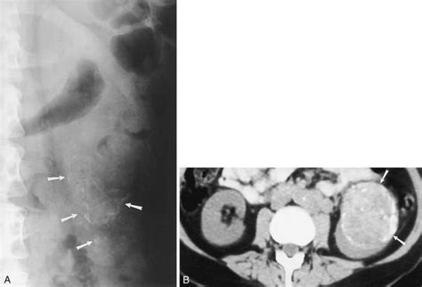 Renal Masses Clinical Tree