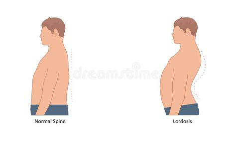 Lordosis Vector Illustration Stock Vector Illustration Of