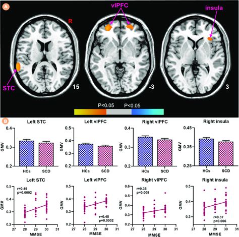 Relationships Between The Gmv And Mmse In Subjective Cognitive Decline Download Scientific