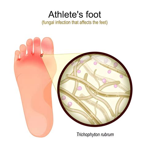 Tinea Pedis Understand And Treat Athletes Foot