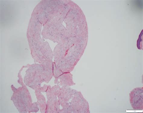 Angioleiomyoma In A Rare Location