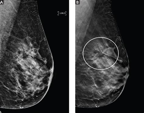Breast Cancer Digital Mammogram
