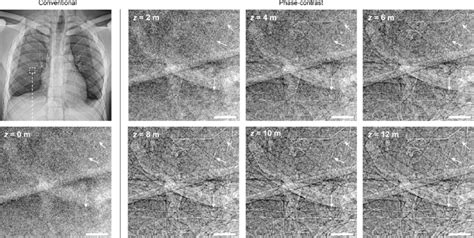 Chest Radiograph Appearance As A Function Of Propagation Distance