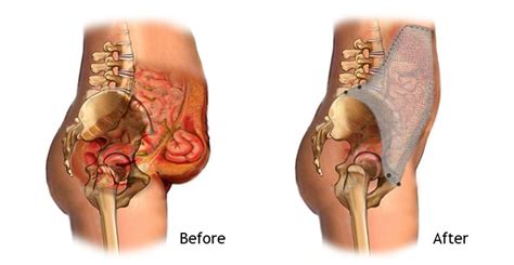 Mastectomy Reconstruction Before And After