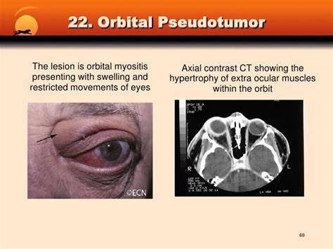 Quiz 25 On Ophthalmoplegia