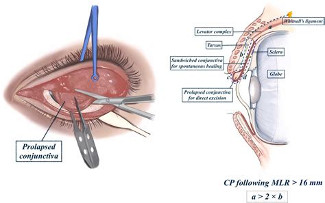 Resolving Conjunctival Prolapse Following Severe Blepharoptosis