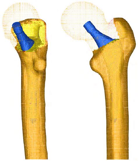 Figure 11 From Simulation By Finite Elements Of Bone Remodelling After