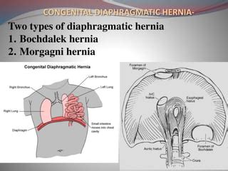 Herniapdf