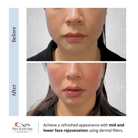 Juvéderm® Toronto Markham Dermal Fillers Lip Cheek Chin Fillers