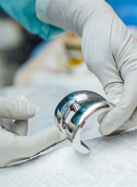 Close Up View Of Metal Implant Holding Surgery Modern Procedure Stock Image Image Of Disease