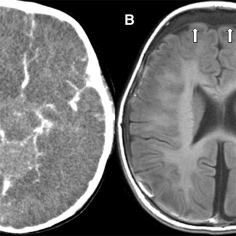 A Brain Ct At Admission Showed Hypoxic Ischemic Encephalopathy With