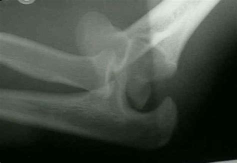 Medial Epicondyle Frx Of The Humerus Wheeless Textbook Of Orthopaedics