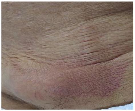 Groin Abscess Female
