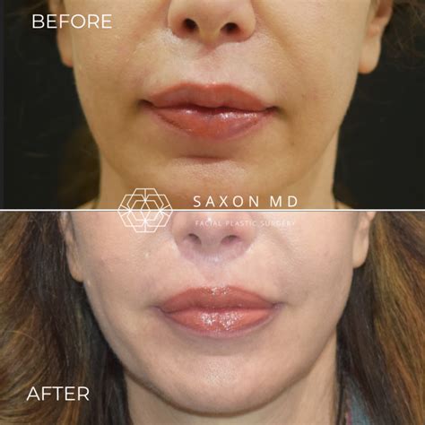 Lip Lift Before And After Photos Austin And Dallas Tx
