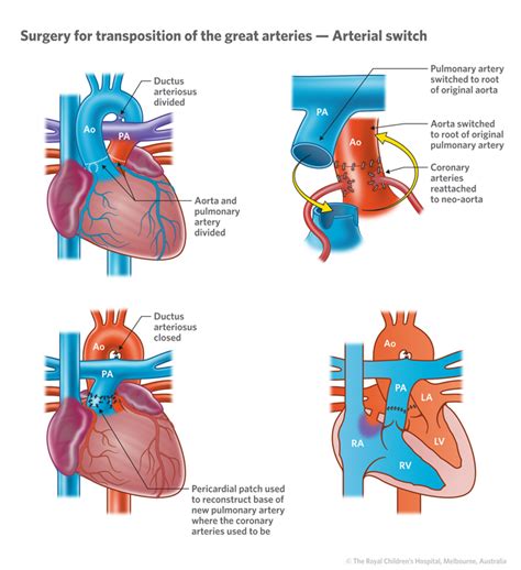 Transposition Of The Great Arteries Post Delivery Graphic Anatomy Ob
